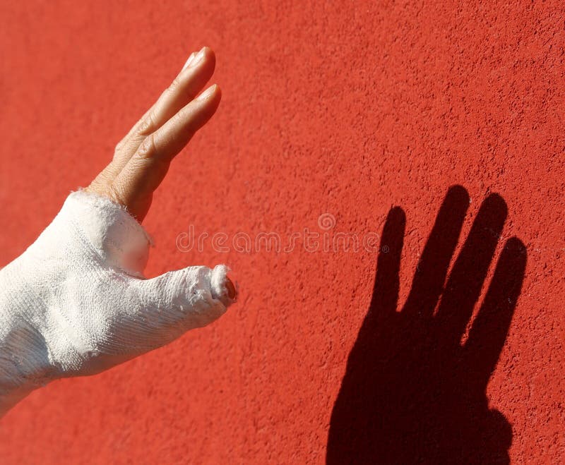 Hand Plaster Especially the Thumb Stock Image - Image of bandage, rift ...