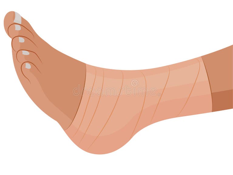 Fractured Leg stock vector. Illustration of concept - 345456766