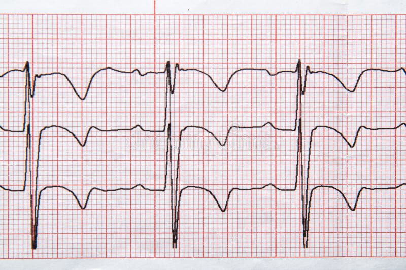 Fragment of a Normal Children`s Electrocardiogram with Arrhythmia ...