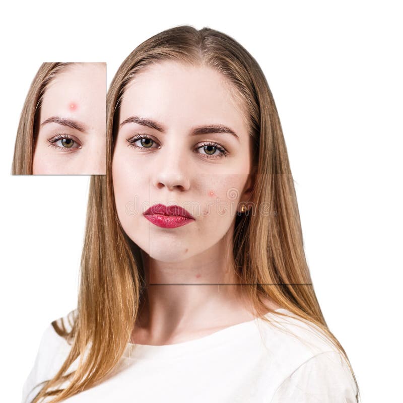 Frames With Problem Skin On Woman Face Stock Image - Image of hygiene ...