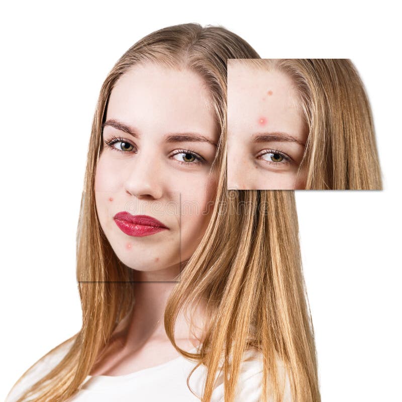 Frames with Problem Skin on Woman Face Stock Image - Image of ...