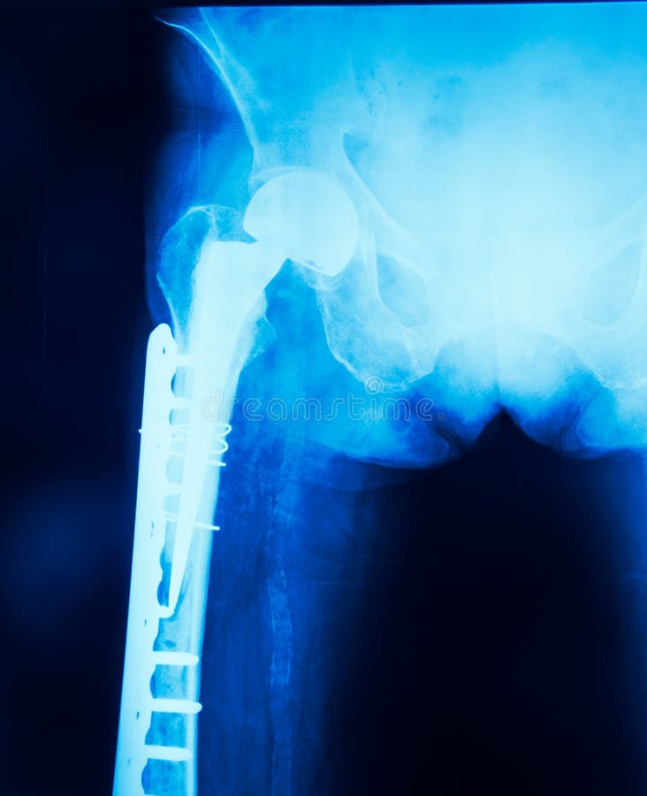 Femore di frattura fotografia stock. Immagine di malato - 48513356