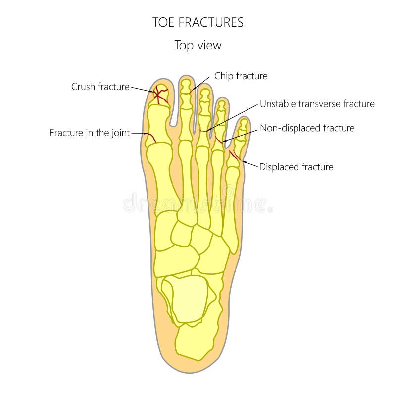 Fratture Del Dito Del Piede Illustrazione Vettoriale - Illustrazione di ...