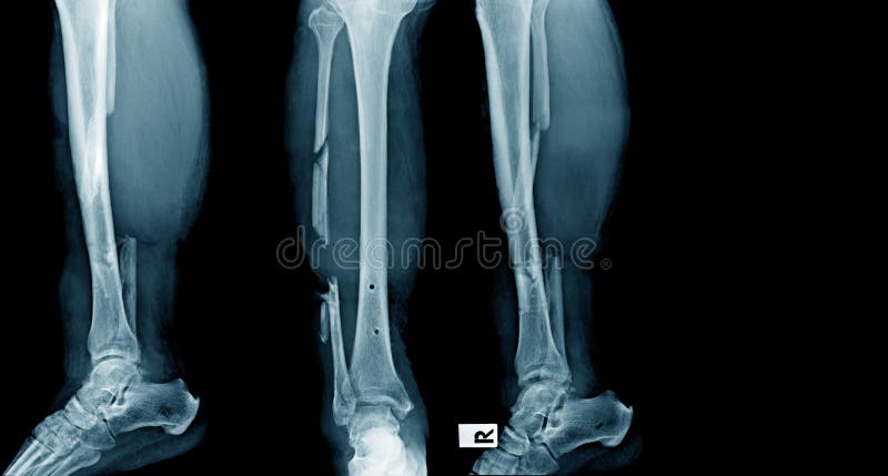 Fratura Do Osso Fibular E Tibial Foto de Stock - Imagem de foto ...