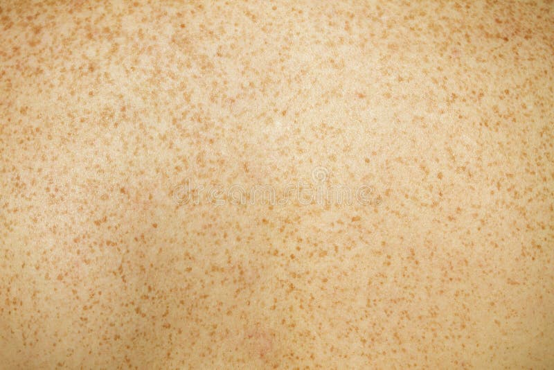 Freckled Back Skin stock photo. Image of back, clusters - 23921890