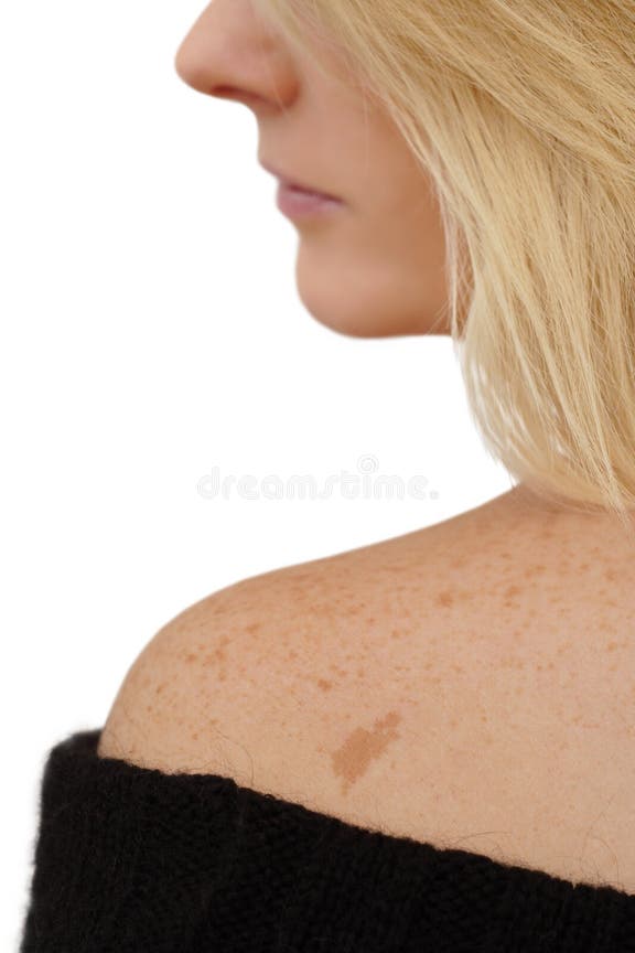Freckles & Birth mark stock photo. Image of face, person - 519312