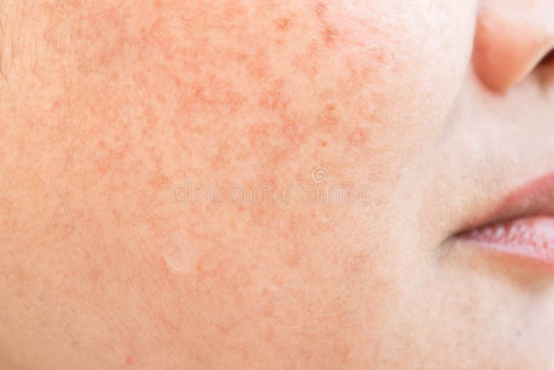 Freckles on the face stock image. Image of people, dermatology - 125712641