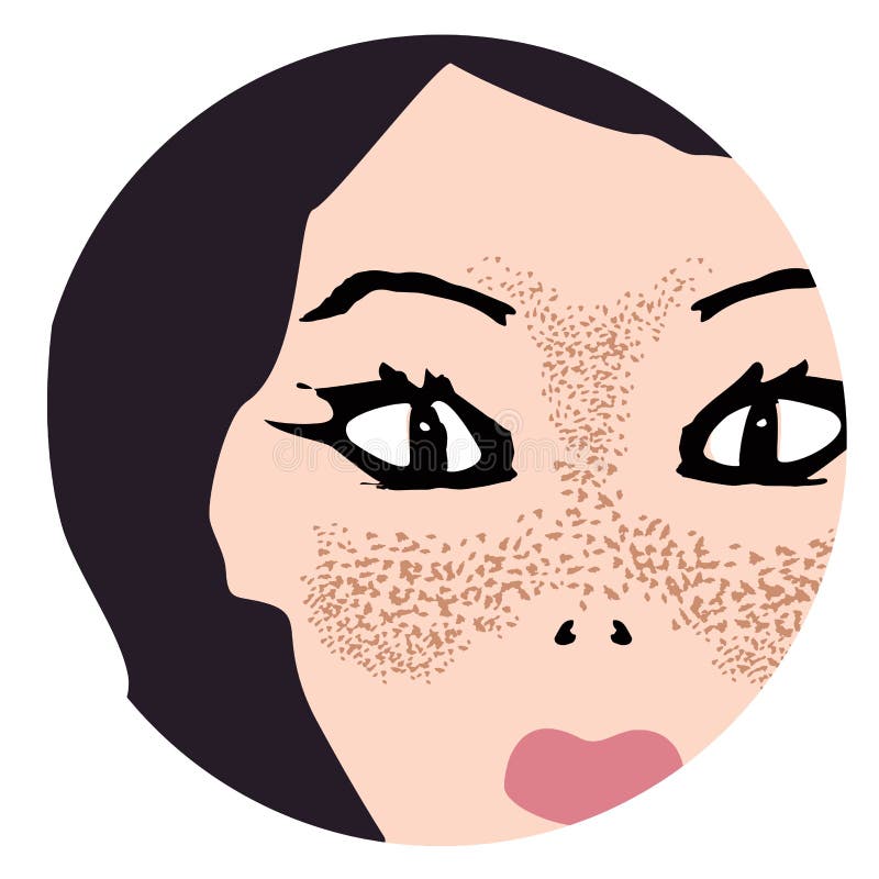 Freckles on the Face. Pigmentation on the Skin. a Pigmented Spot on the ...