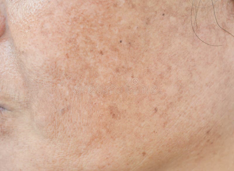 Freckles on the face stock photo. Image of face, hair - 125392588