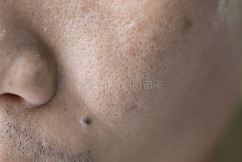 Asian Face, Skin Problems stock image. Image of health - 158377183