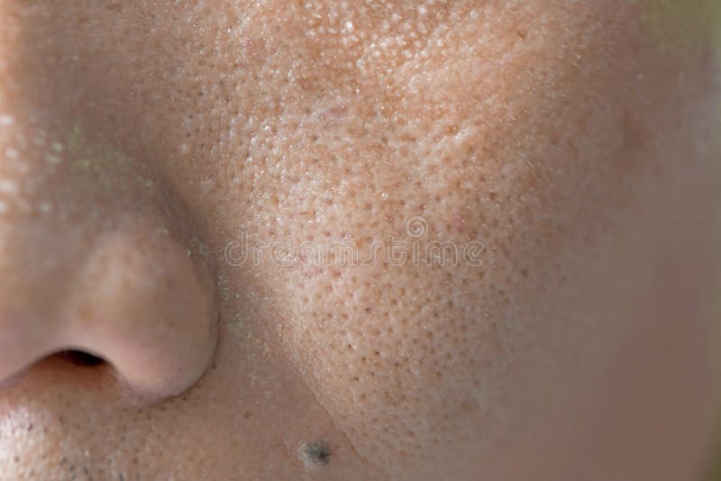 Asian Face, Skin Problems stock image. Image of beauty - 158377187