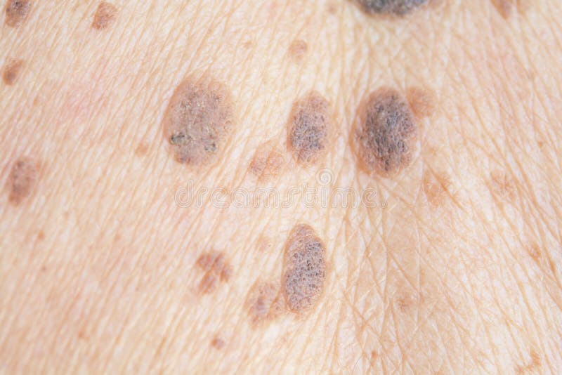 Freckles on the skin stock photo. Image of back, white - 126991924