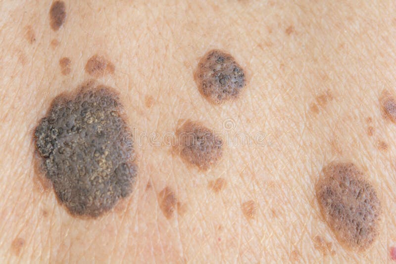 Freckles on the skin stock image. Image of treatment - 126991991