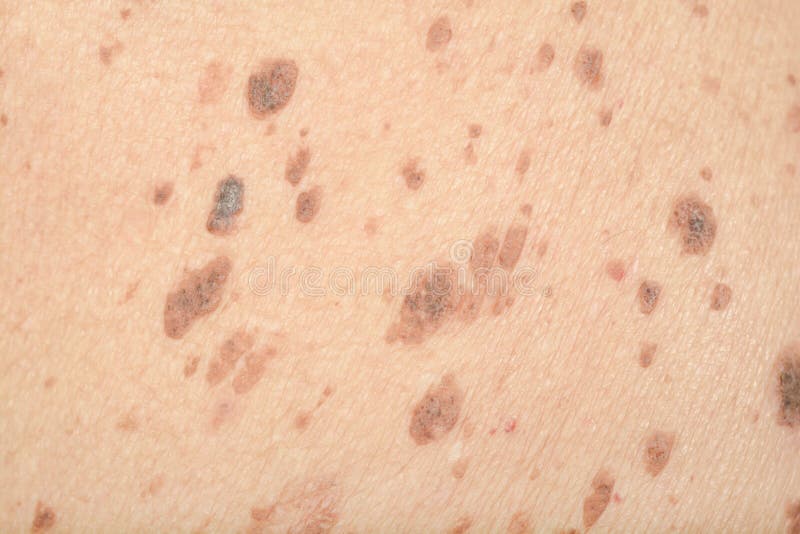 Freckles on the skin stock image. Image of freckles - 125395655