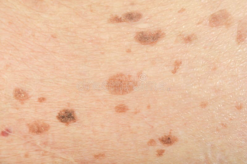 Freckles on the skin stock photo. Image of problems - 125395624