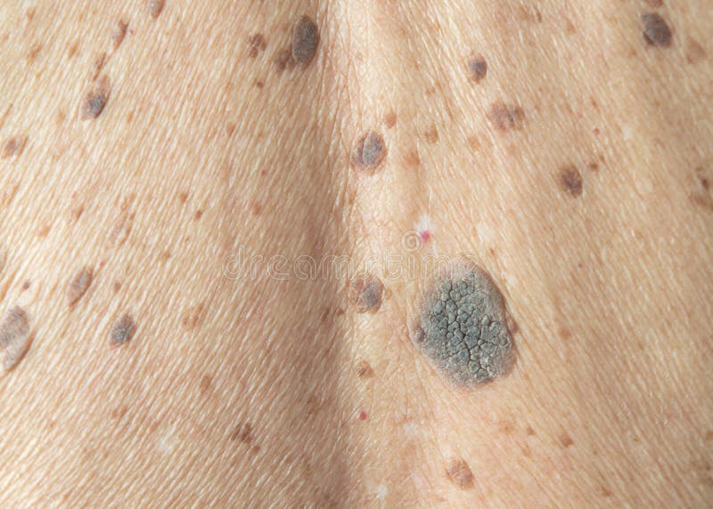 Freckles on the skin stock image. Image of female, problems - 126991985