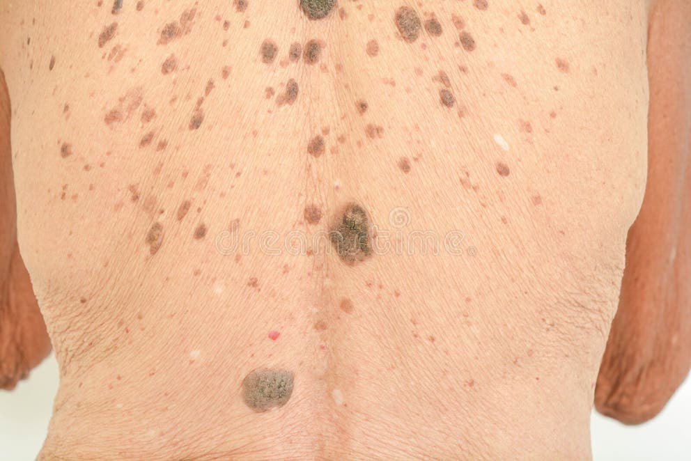Freckles on the skin stock photo. Image of skin, acne - 125395692