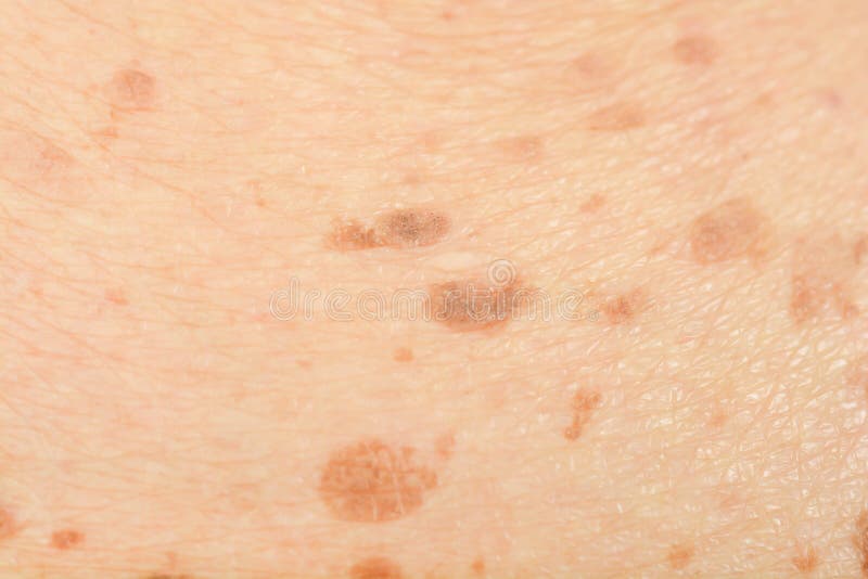 Freckles on the skin stock photo. Image of person, female - 125395656