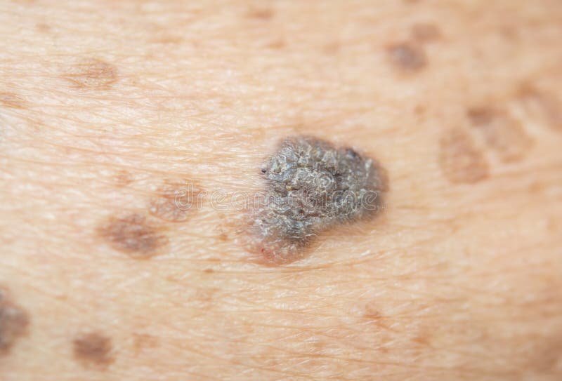 Freckles on the skin stock image. Image of itching, problems - 127558235