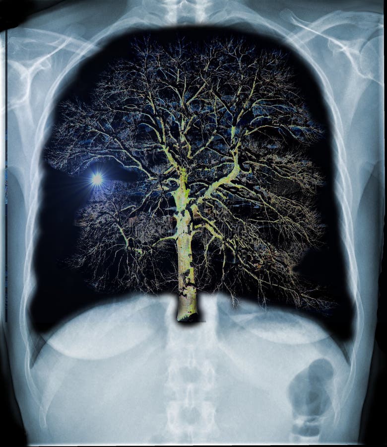 23,775 Lungs Photos - Free & Royalty-Free Stock Photos from Dreamstime