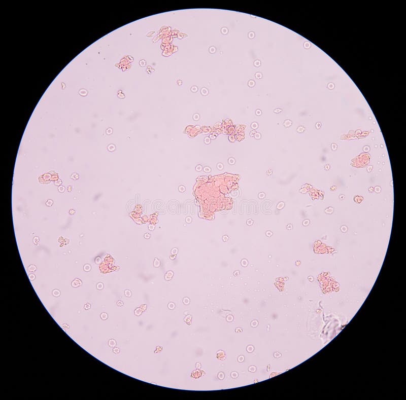 Fresh Red Blood Cell in Urine Stock Photo - Image of agglutination ...