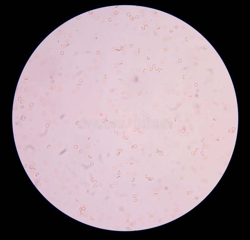 Fresh Red Blood Cell in Urine Stock Photo - Image of agglutination ...