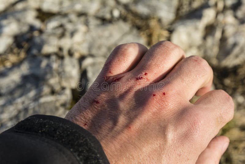 Hand Laceration Stock Images - Download 182 Royalty Free Photos