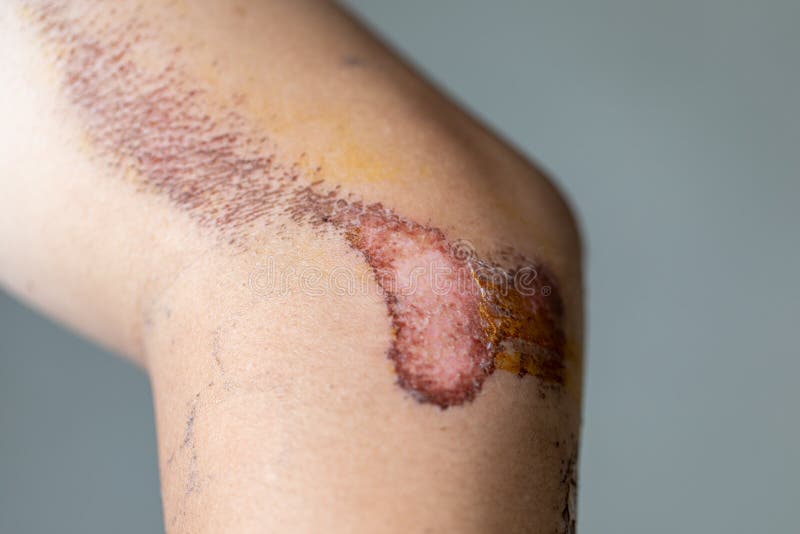 Fresh Wounds from Accident. Stock Photo - Image of fracture, macro ...