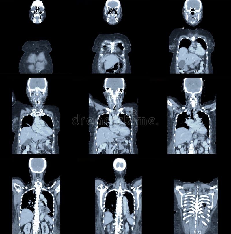 X-ray image mri scan stock image. Image of diaphragm - 238675789