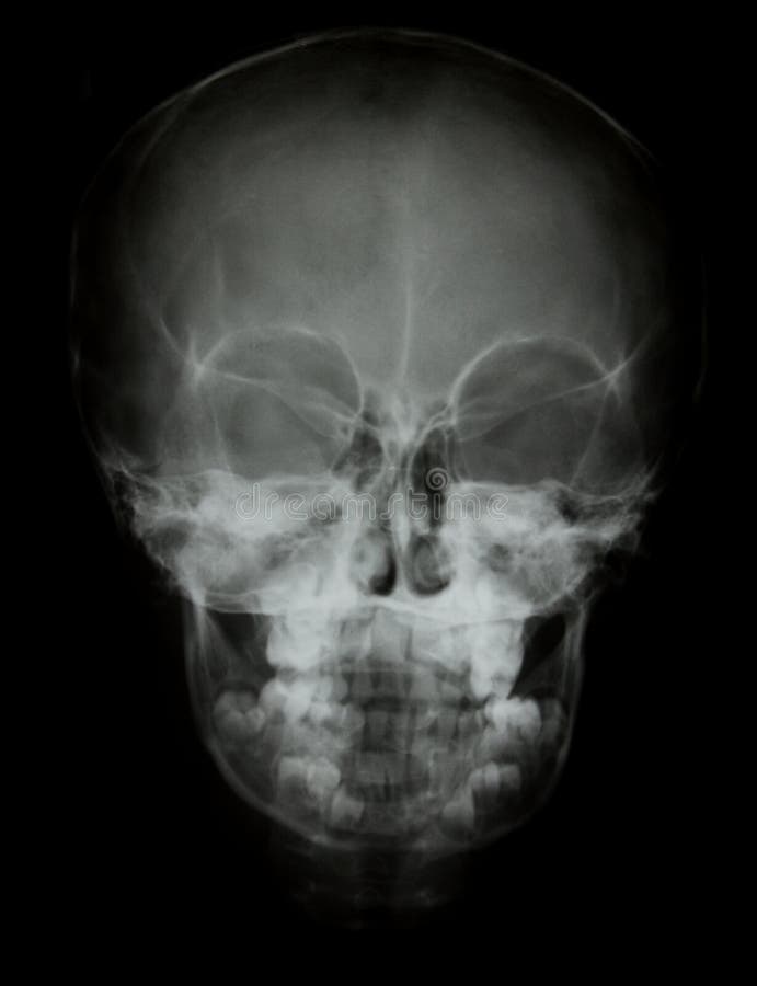 Skull xray stock photo. Image of examination, skeleton - 19001360