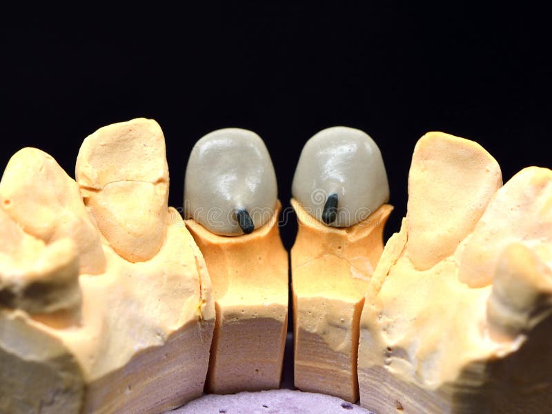 Front teeth dental implant stock image. Image of bridge - 35668183