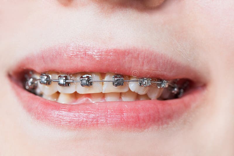 Front View of Dental Braces on Teeth of Upper Jaw Stock Photo - Image ...