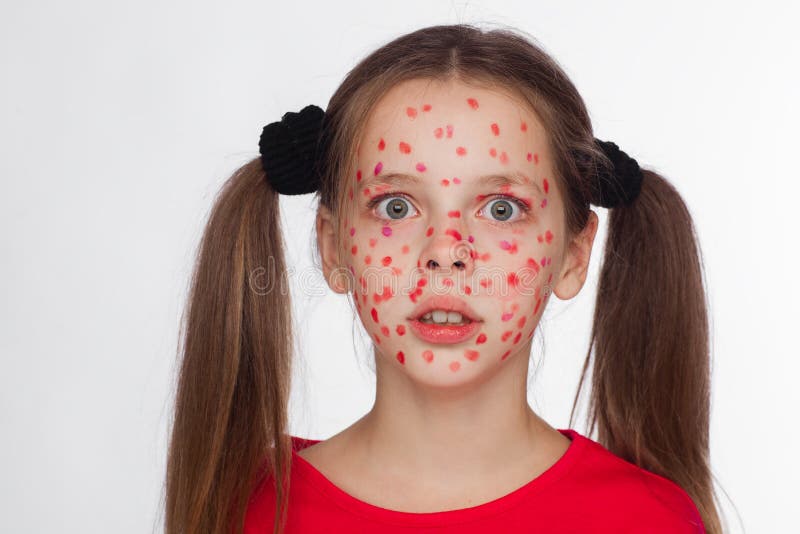 Front View of a Girl with a Problem Skin Rash Stock Image - Image of ...