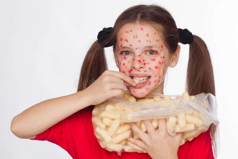 Front View Of A Girl With A Problem Skin Rash Who Eats Corn Sticks ...