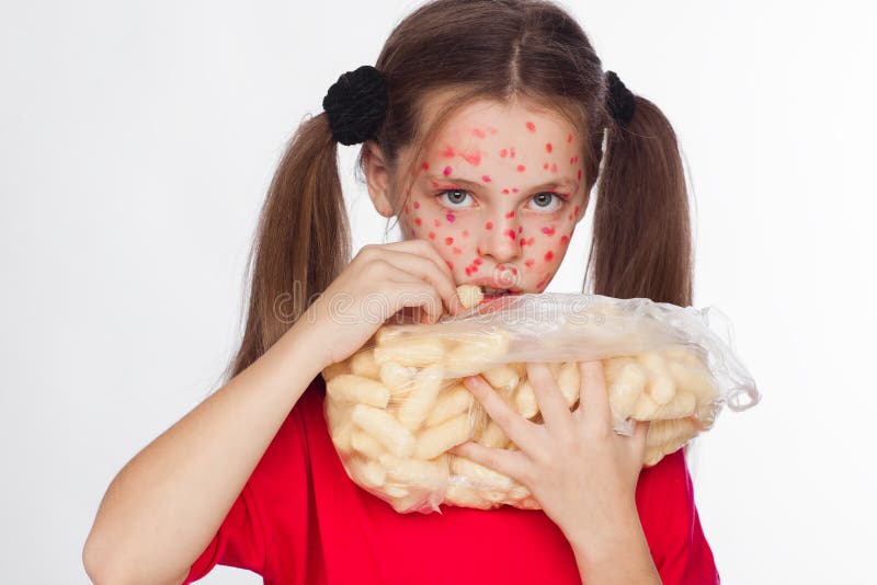 Front View Of A Girl With A Problem Skin Rash Who Eats Corn Sticks ...