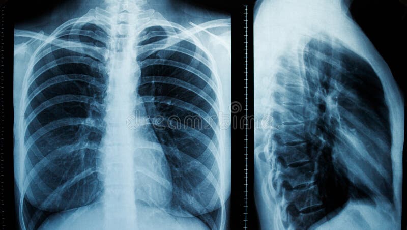 Frontal and Lateral Projections of a Female Chest X-ray Stock Photo ...