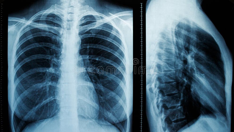 Frontal and Lateral Projections of a Female Chest X-ray Stock Photo ...