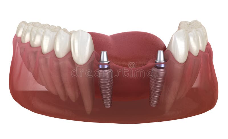 Frontal Teeth Bridge Supported by Implants. Medically Accurate 3D ...