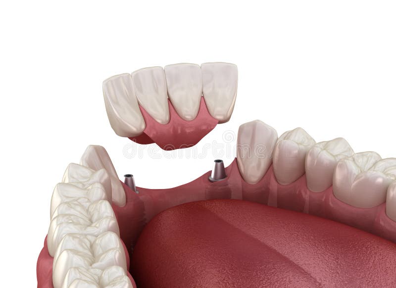 3d Render Dental Bridge Dental Crowns Stock Illustrations – 46 3d ...