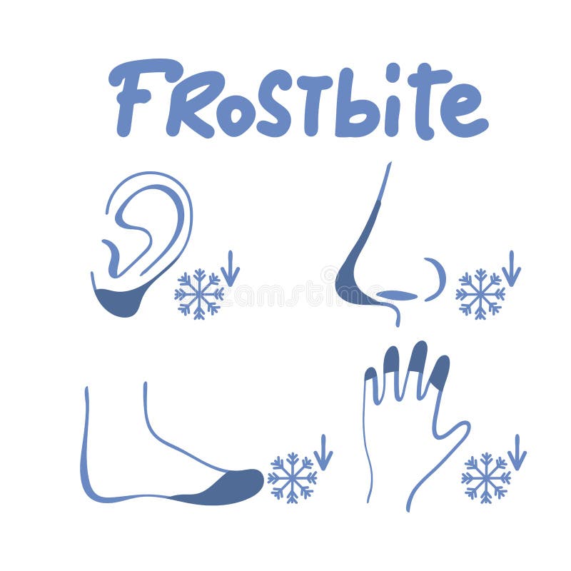 Frostbitten Vector Stock Illustrations – 141 Frostbitten Vector Stock ...