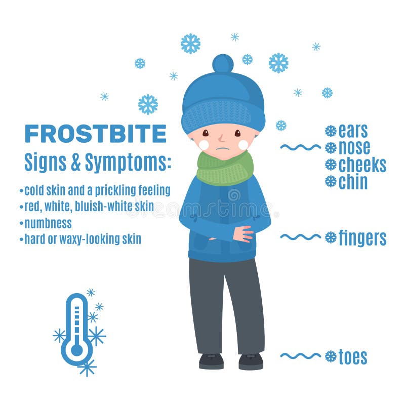 Frostbite First Aid Infographic. Hypothermia In Cold Winter Stock ...