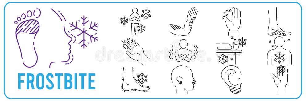 Frostbite. Symptoms, Line Icons Set Stock Vector - Illustration of pain ...