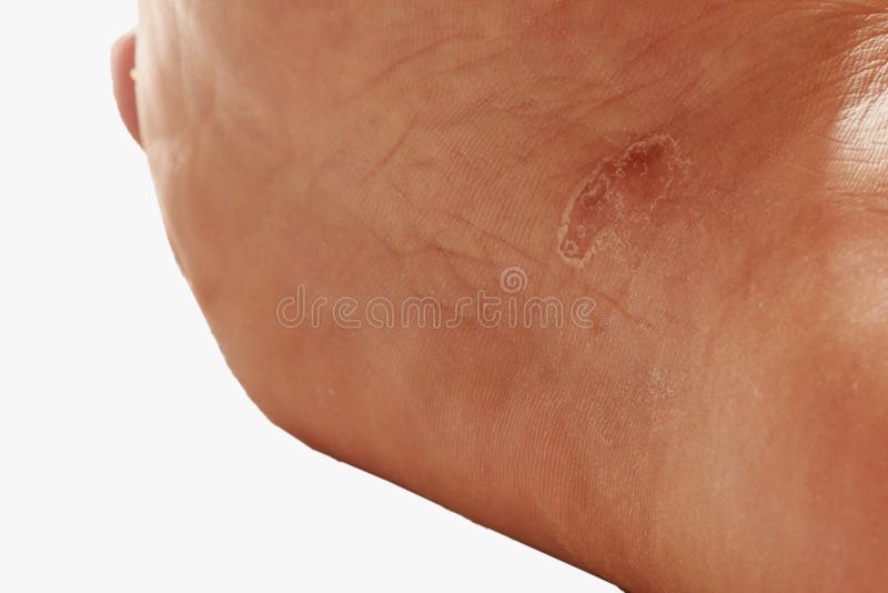 Mykose stockbild. Bild von gesundheit, hautentzündung - 81254657