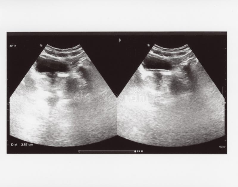 Full Abdomen Ultrasound Sonogram Stock Photo - Image of ultrasonic ...