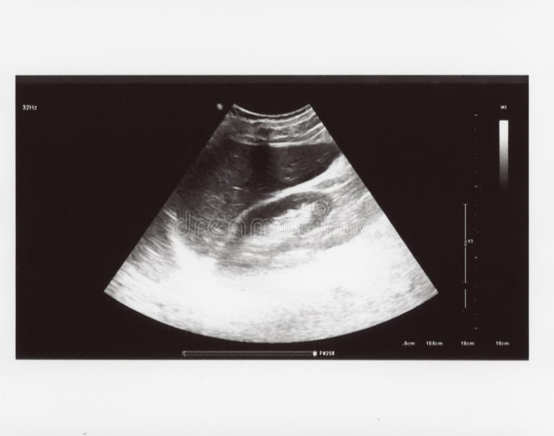 Full Abdomen Ultrasound Sonogram Stock Image - Image of pharmacy ...