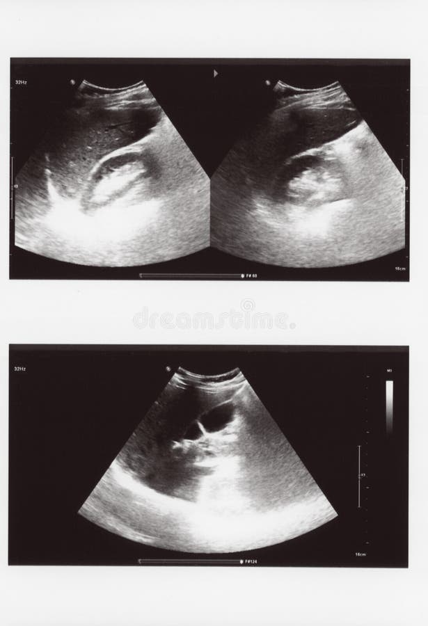 Full Abdomen Ultrasound Sonogram Stock Image - Image of pharmacy ...