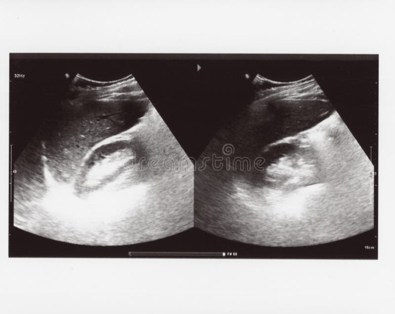 Full Abdomen Ultrasound Sonogram Stock Photo - Image of diagnostics ...