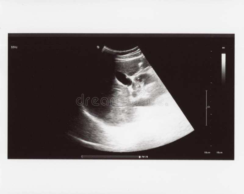 Full Abdomen Ultrasound Sonogram Stock Image - Image of kidney, health ...