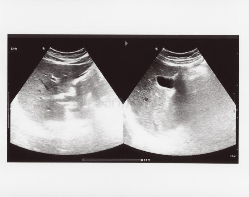 Full Abdomen Ultrasound Sonogram Stock Image - Image of hospital ...