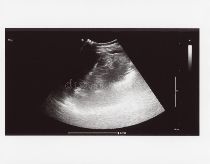 Full Abdomen Ultrasound Sonogram Stock Photo - Image of sonografie ...